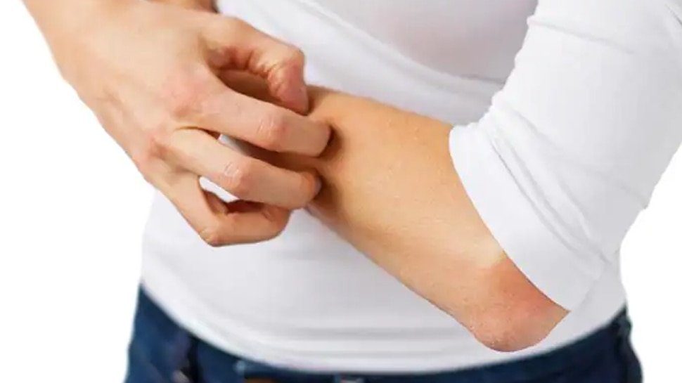 Soap Allergy: remedies and preventive measures | Soap Allergy: സോപ്പ് ...
