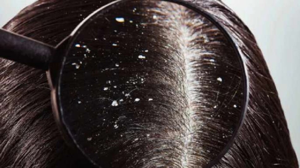 Dandruff Problem follow these home remedies if you are troubled by ...