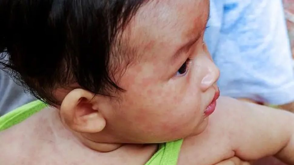 Measles Outbreak In Mumbai How To Protect Your Child Against Measles ...