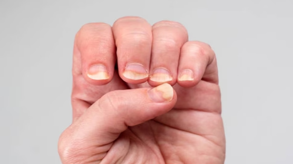 Cancer Symptoms|Finger Nails gives the symptoms of cancer|കയ്യിലെ നഖം ന ...