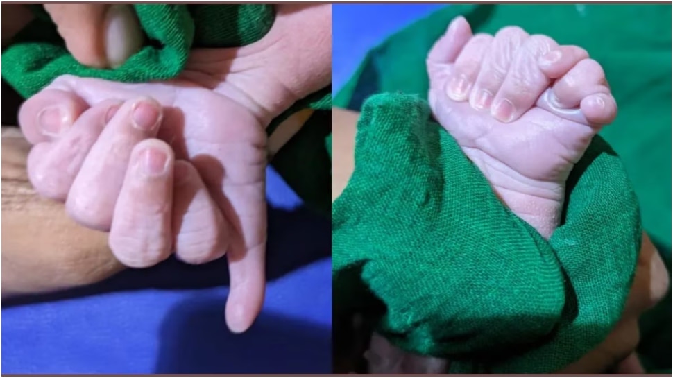 Baby born with 13 fingers and 12 toes in Bengaluru Karnataka | കയ്യിലും ...
