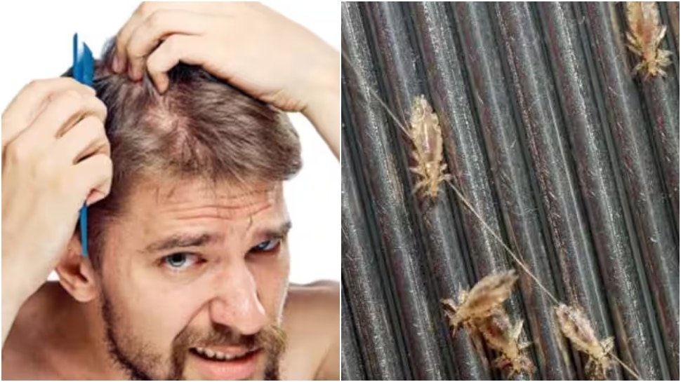 Lice Home Remedies: Follow these 3 home remedies to get rid of lice ...