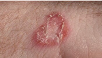 Ring Worm News in Malayalam Latest Ring Worm news, photos, videos | Zee ...